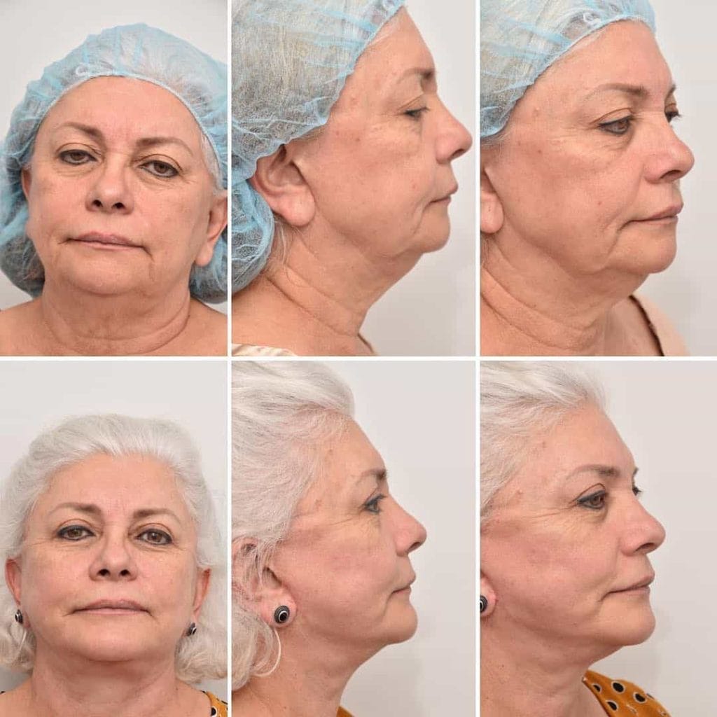 Neck Lift by Dr. Spera: Expert Plastic Surgery in Miami