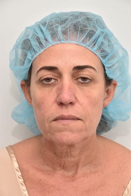 Deep Plane Facelift by Dr. Spera: Top Plastic Surgery in Miami