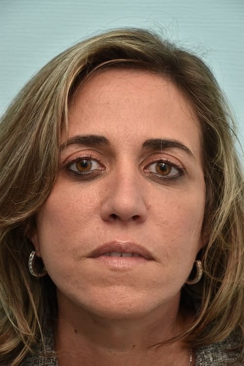 Deep Plane Facelift by Dr. Spera: Top Plastic Surgery in Miami