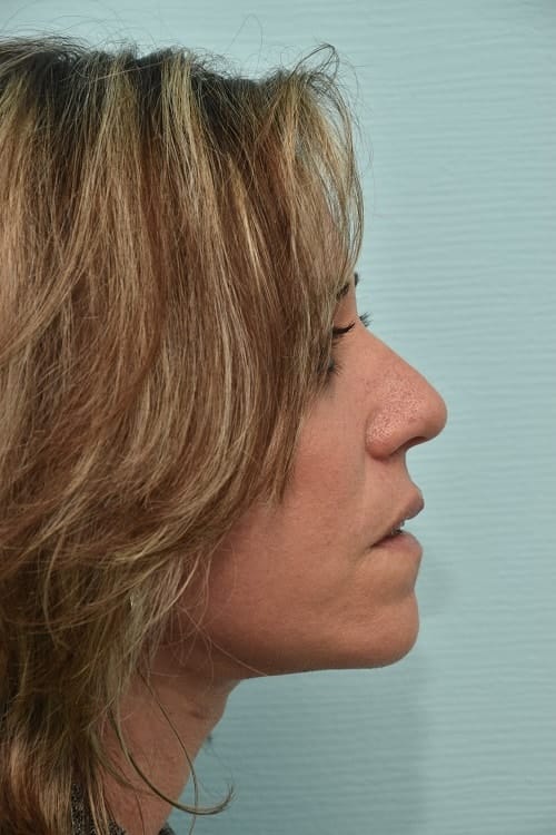 Deep Plane Facelift by Dr. Spera: Top Plastic Surgery in Miami