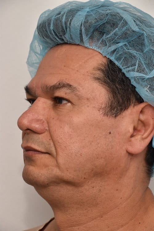 Deep Plane Facelift by Dr. Spera: Top Plastic Surgery in Miami