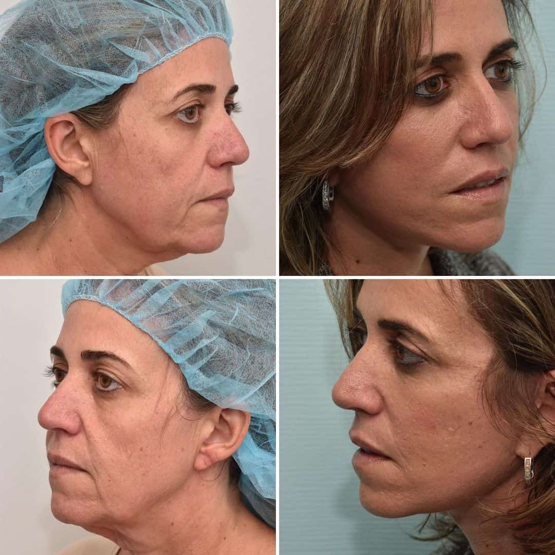Deep Plane Facelift by Dr. Spera: Top Plastic Surgery in Miami
